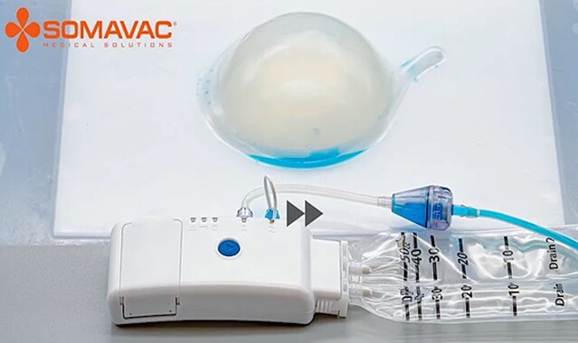 装着期間、感染リスク、ストレスが減少！ 乳がん患者の悩みに寄り添うドレーン機器「SOMAVAC SVS」に全米が注目 - ライブドアニュース